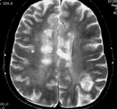 Brain Imaging In Multiple Sclerosis Practice Essentials Computed