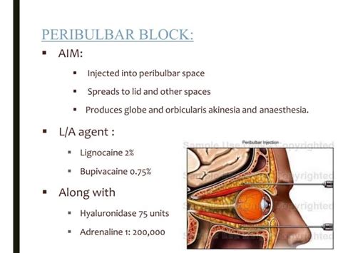 Ocular Anesthesia Pptx