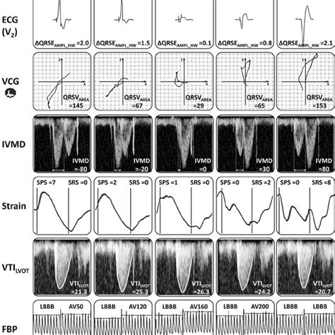 Qrs Vector Amplitude And Direction For The Different Pacing