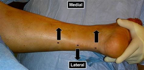 Surgical Correction Of Soft Tissue Ankle Equinus Contracture Clinics