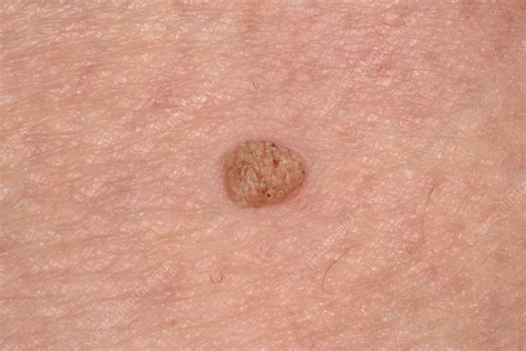 Filiform Wart On A Womans Knee Stock Image C058 5597 Science Photo Library