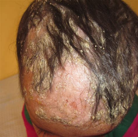 Fungal Infections Dermalive