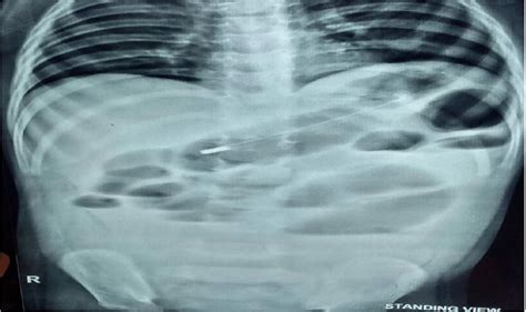 X Ray Abdomen Erect Showing Multiple Air Fluid Levels Download Scientific Diagram