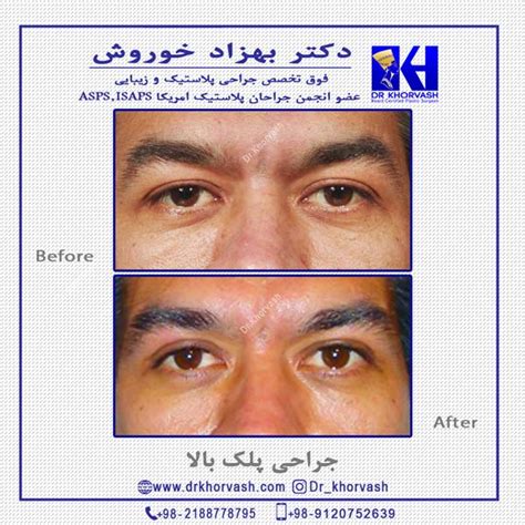 تصاویر نمونه جراحی های پلک دکتر خوروش
