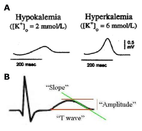 A Alterations In T Wave Due To Different Potassium Level 14 B A