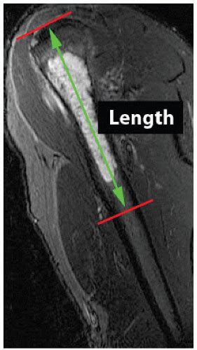 Proximal Humeral Allograft Prosthetic Composites Musculoskeletal Key