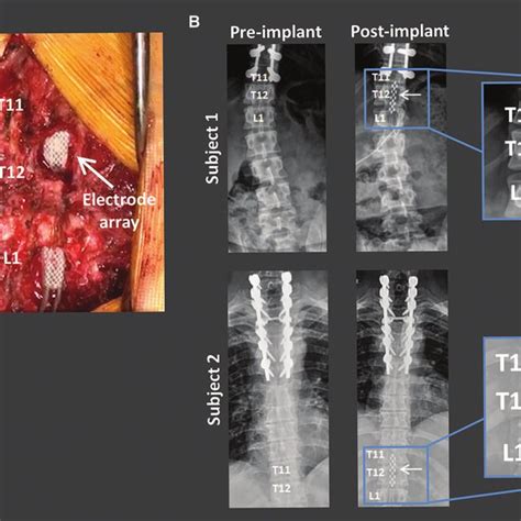 Pdf Electrophysiological Guidance Of Epidural Electrode Array