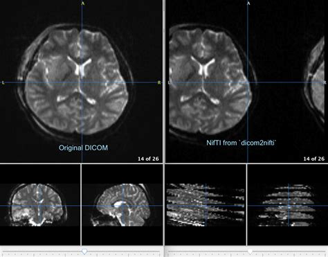 Strange Siemens Mosaic Dwi To Nifti Conversion When Dicom Has Incorrect