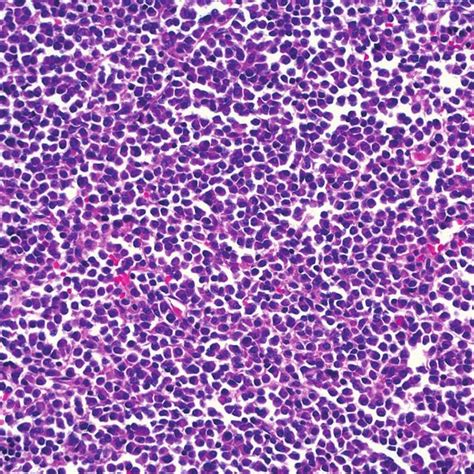 Immunohistochemistry Evidenced Kappa Immunoglobulin Light Chain A Download Scientific Diagram