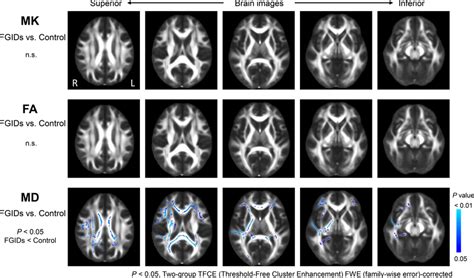 Voxelwise Statistical Analyses Of The Diffusion Kurtosis And Tensor