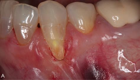 Clinical Considerations For Root Coverage Procedures Decisions In