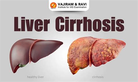 Liver Cirrhosis Definition Symptoms Treatment Latest News