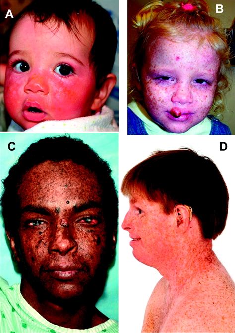 Xeroderma Pronunciation