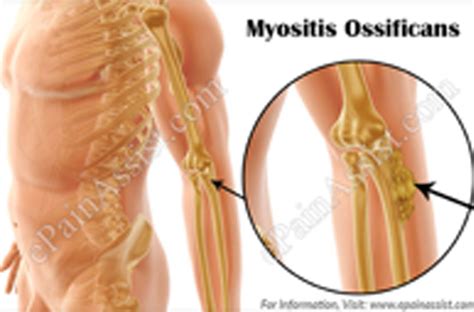 Myositis