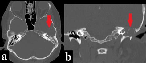 Scutum Temporal Bone