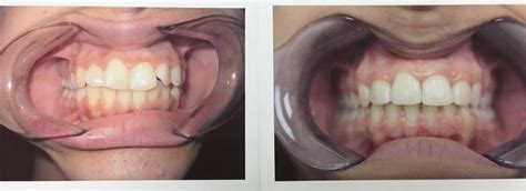 The Different Types Of Braces Aesthetic Dental