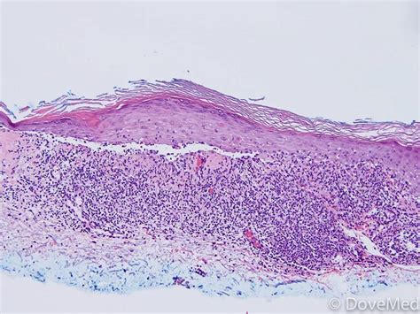 Lichen Planus Of Vulva DoveMed