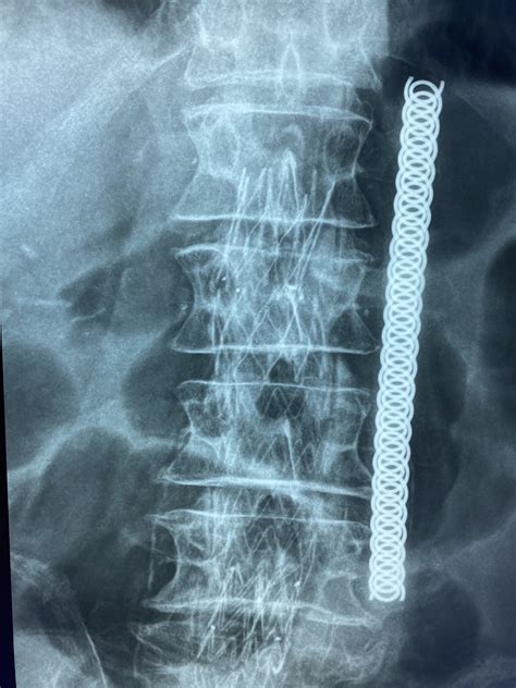 My Mri And Ct Images Basilar Invagination Chiari I Have Osteogenesis Imperfecta Type 1 Which