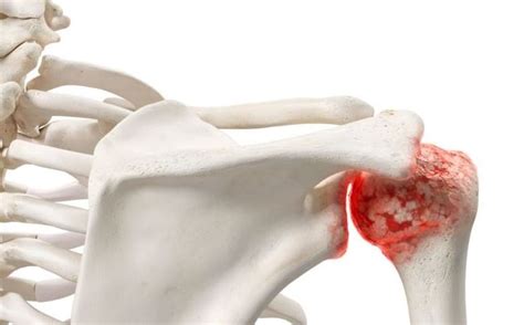 Prothèse Totale De Lépaule En Cas Darthrose Santé Orthopédique