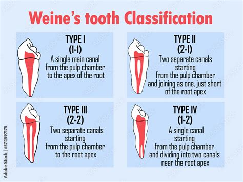 Weines Classification Of Root Canal Morphology From Type I To Type Iv Weines Classification