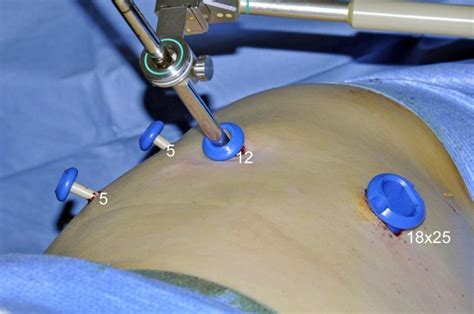 Thoracoscopic Right Upper Lobectomy Using A Full Posterior Dissection Ctsnet Dissection