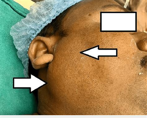 Right Parotid Gland Swelling Immediate Post Surgery Download Scientific Diagram