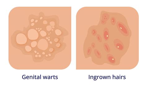 Symptoms And Signs Of Genital Warts In Women At Early Stages