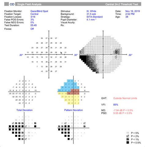 Measurement And Regionalized Of The Visual Field Vf Were