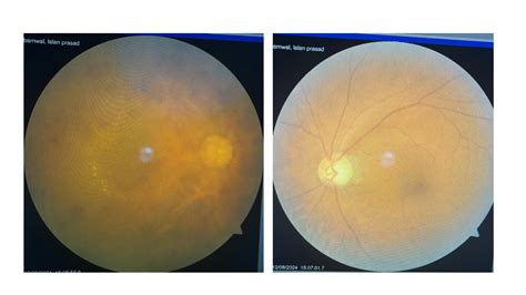 Neovascular Glaucomapptx Pptx