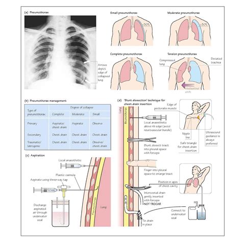 Pneumothorax Pediagenosis
