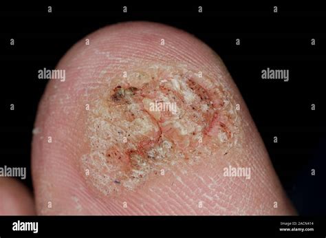 Close Up Of A Verruca Wart On The Big Toe In A 47 Year Old Male Patient This Plantar Wart Is