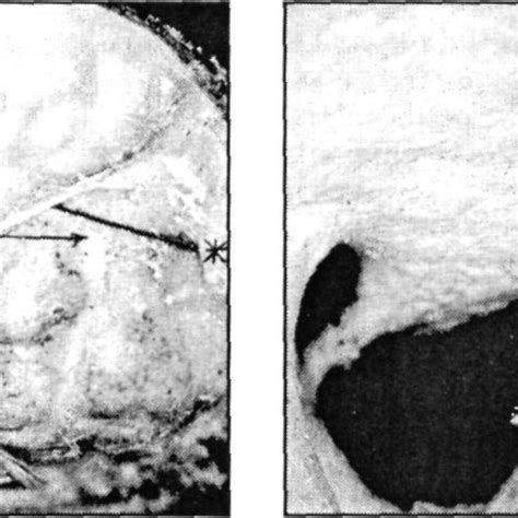 Communication Openings Between The Orbit And Middle Cranial Fossa On Download Scientific