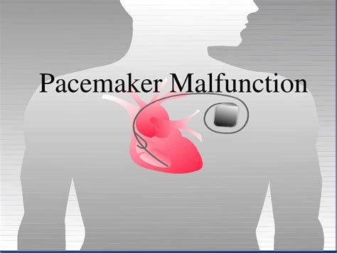 Ppt Pacemaker Malfunction Powerpoint Presentation Free Download Id 5755499