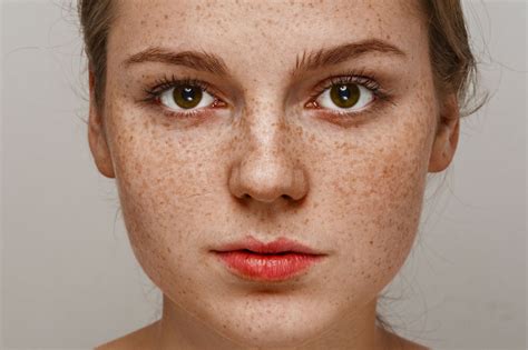 Are Freckles Genetic Can You Get Rid Of Them Curology