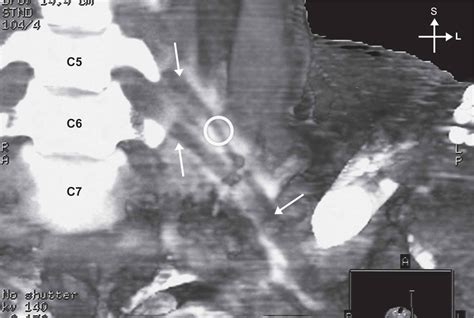 Interscalene Brachial Plexus Block Anesthesia Key