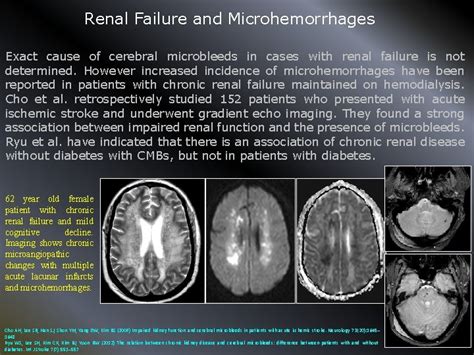 Cerebral Microbleeds Causes Clinical Relevance And Imaging Approach