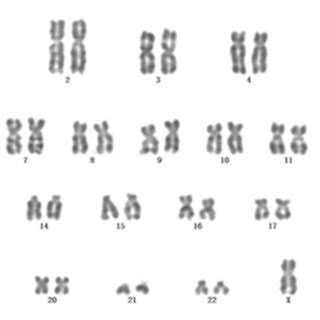 Karyotype Analysis 45 X Y [20] All The Cells Analyzed Had Y