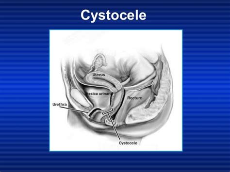 Cystocele Grading