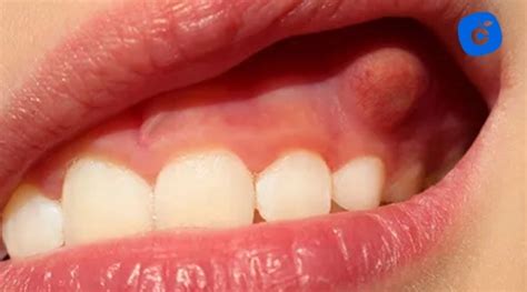 Concusión Dental