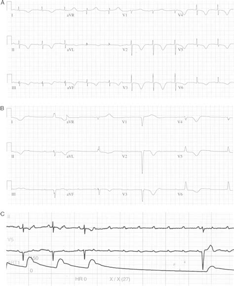 A Initial Ecg Showing Widespread T Wave Inversion And Qt Interval