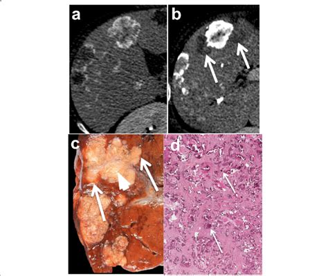 Calcifications Of Liver Metastases Induced By Chemotherapy In A
