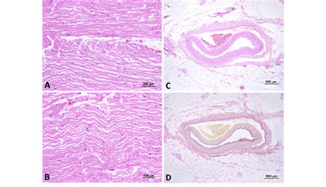 Cardiac Histological Findings A B Interstitial Swelling Stretching