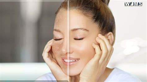 Melasma On Your Upper Lip Woms