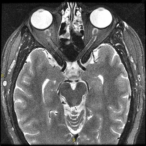 Optic Neuritis Mri Stock Image C0271854 Science Photo Library