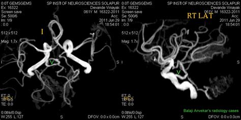 Dr Balaji Anvekars Neuroradiology Cases Persistent Trigeminal Artery