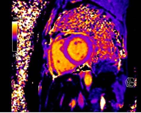 Mri Cardiac T1 Mapping T2 Mapping And T2 Mapping