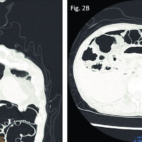 A B Abdominal Ct Scan Reveals The Improvement Of Pneumoperitoneum