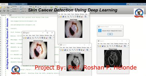 Skin Cancer Detection Using Deep Learning Cnn Skin Cancer Prediction