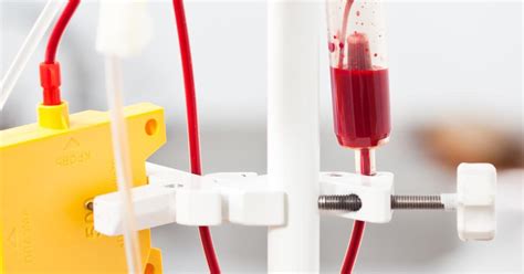 Multiple Sclerosis And Plasmapheresis Multiplesclerosis