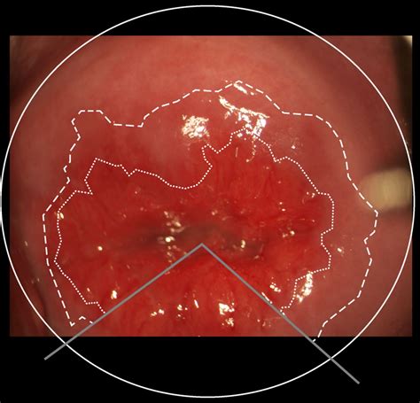 Cervical Ectopy Associations With Sexually Transmitted Infections And Hiv A Cross Sectional